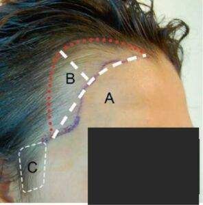 Temple Hair Transplant l 5 Know How from Dr. Doganay