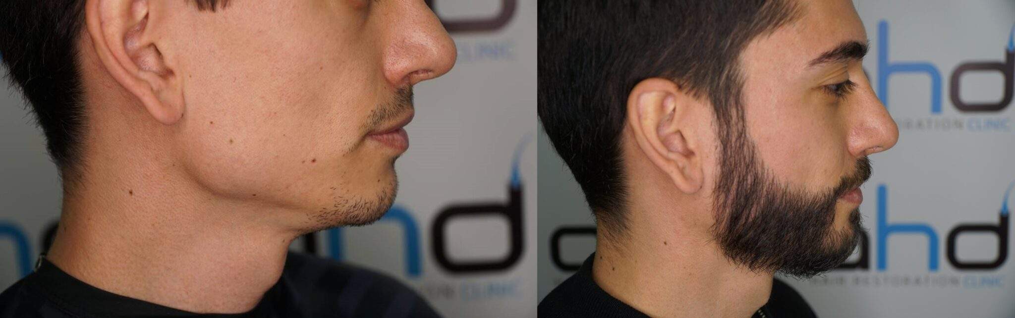 How is Beard Transplant Done? | Methods of Dr. Doganay