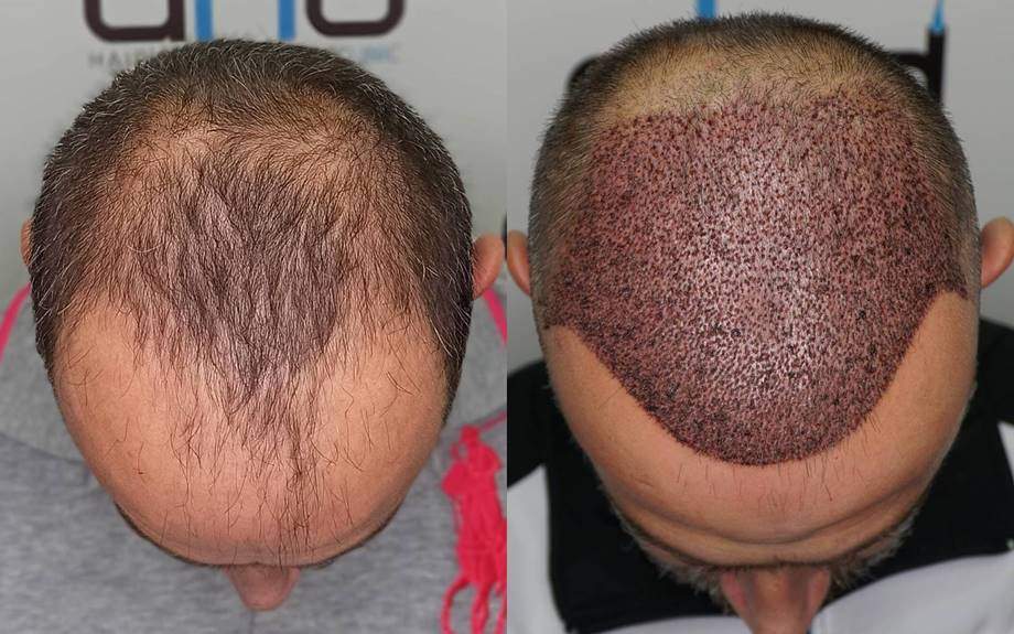 5000 Greft Saç Ekimi | Ahd Saç Ekim Merkezi